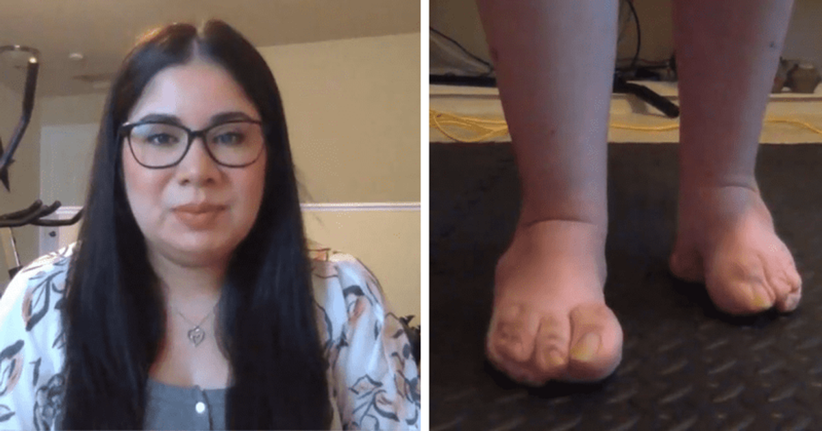 'My Feet Are Killing Me': Emily says she wants to chop off her toe ...