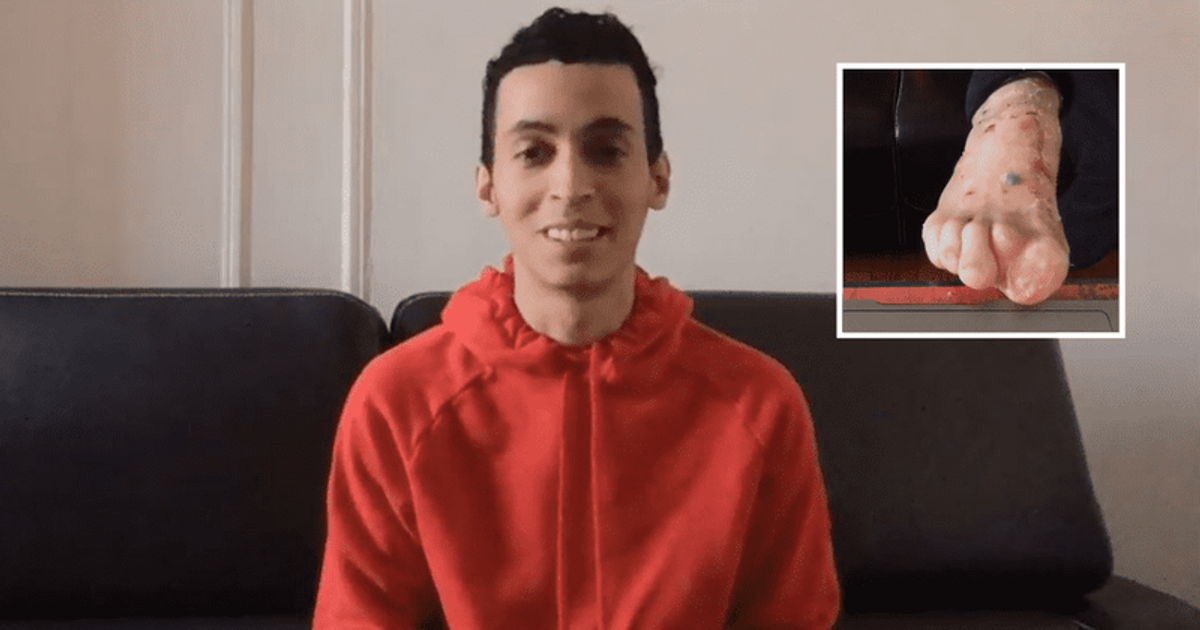 'My Feet Are Killing Me': Gabriel suffers from rare skin condition, can ...