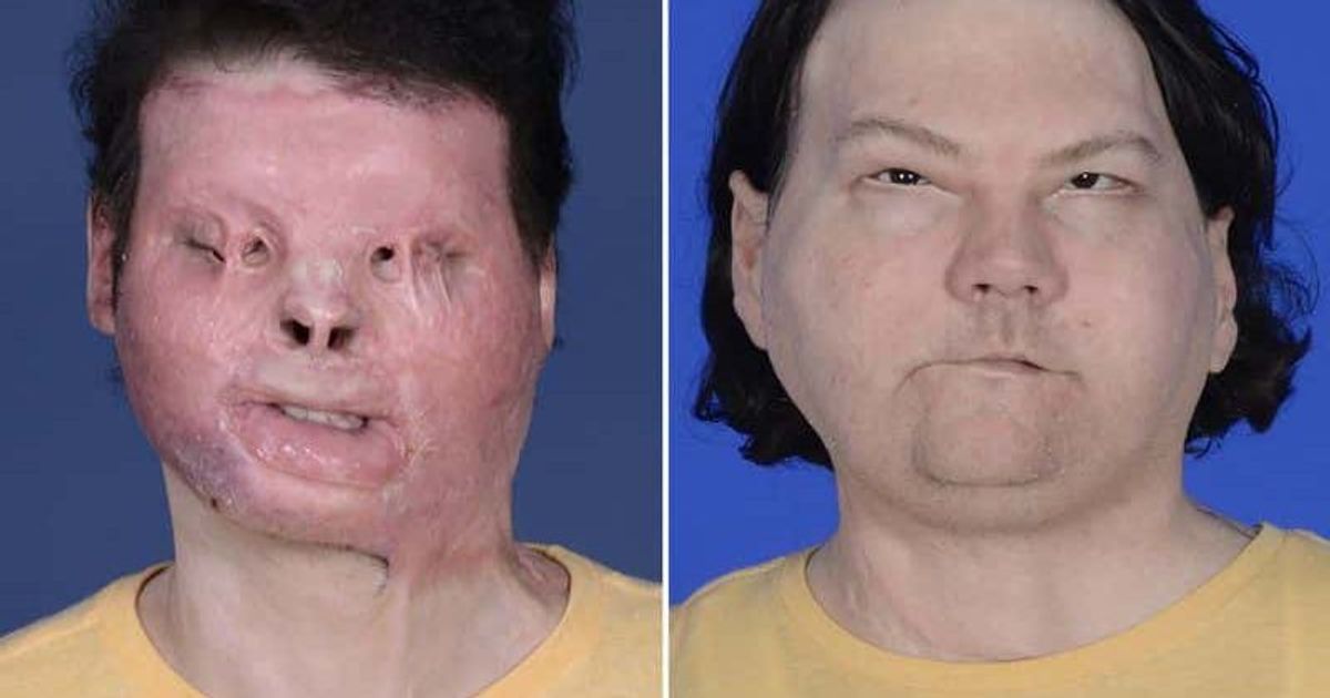 Who is Joe DiMeo? New Jersey burn survivor becomes world's 1st person ...