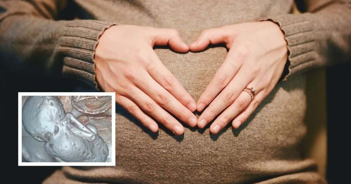 Mummified 'stone baby' found in belly of old woman, 73, which she ...