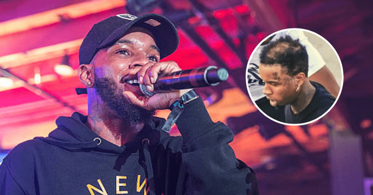 'What’s the big deal?' Rapper Tory Lanez claims he has ALOPECIA after ...