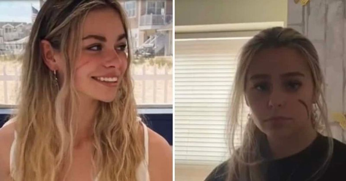 ‘French Scar’: TikTok's self-harming challenge raises concern | MEAWW