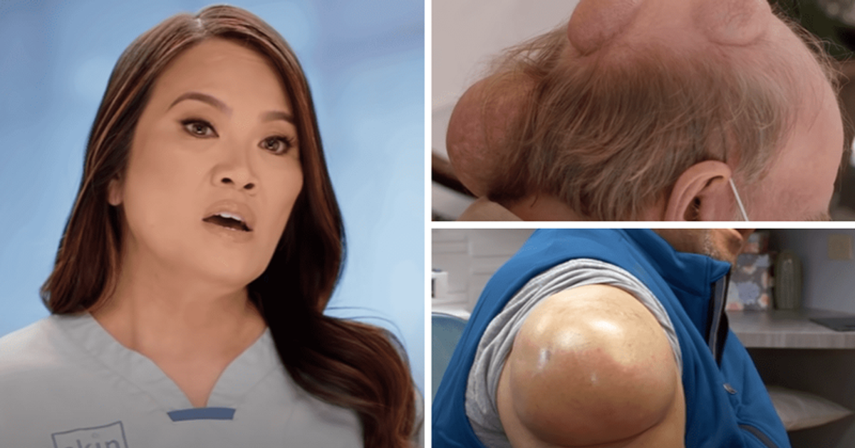 What are the biggest pops on 'Dr Pimple Popper'? | MEAWW