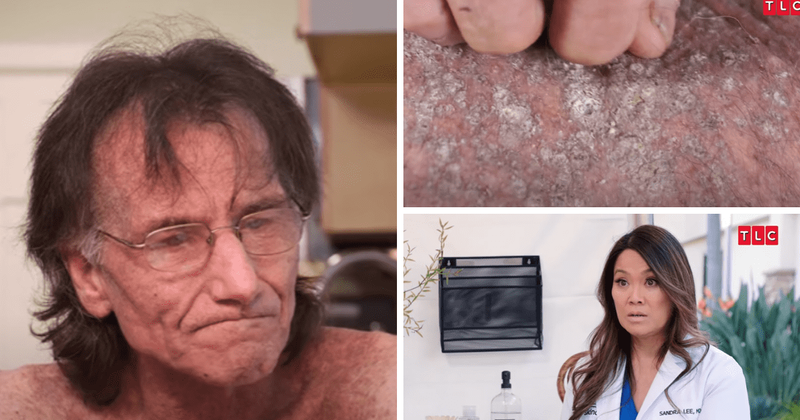 Where is Jimmy now? 'Dr Pimple Popper' cures patient's flaky alligator ...