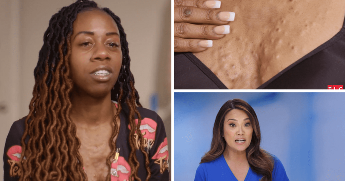 Where is Brittney now? 'Dr Pimple Popper' patient embraces her beauty ...