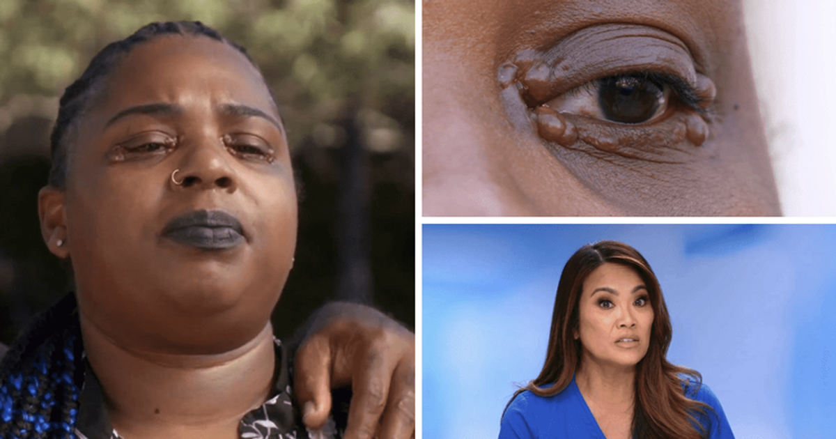 'Dr Pimple Popper': Where is Ebonee now? Dr Sandra Lee helps patient ...