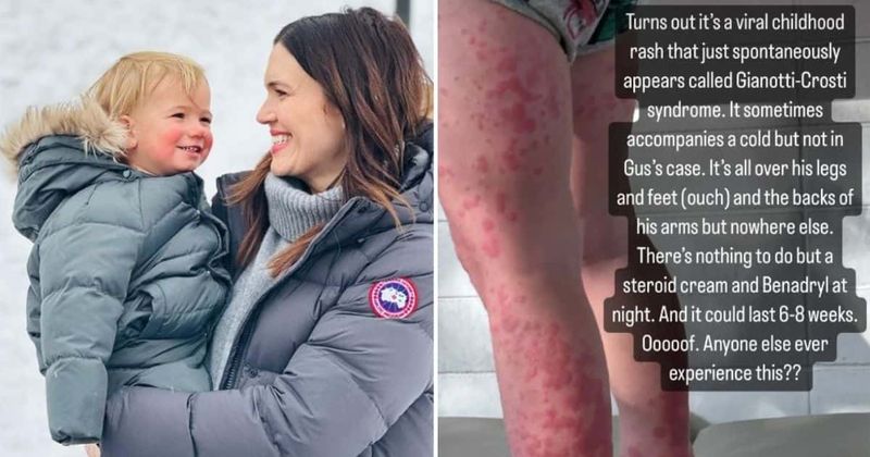 What is Gianotti-Crosti syndrome? Mandy Moore shares her toddler son ...